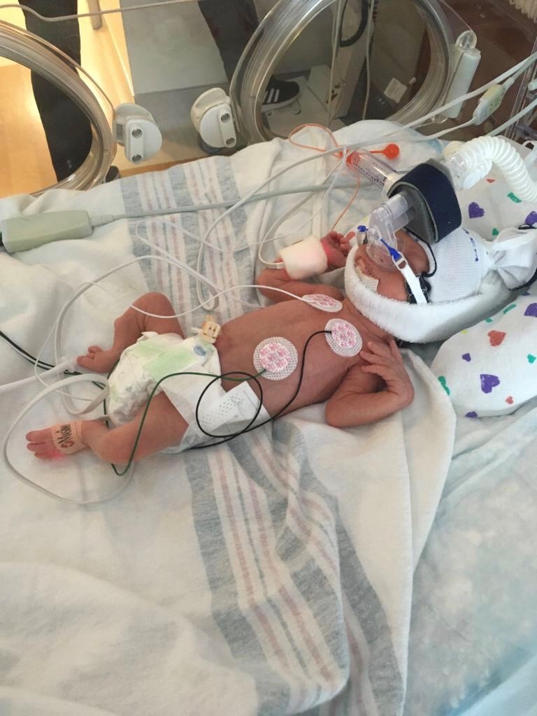 Milestone procedure saves preemie with complex heart disease
