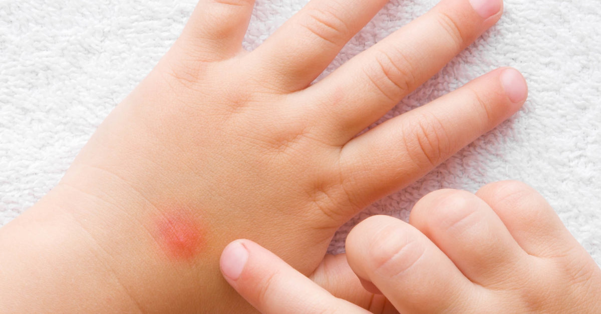 Keep Your Kids Safe from Insects - CHOC - Children's Health Hub