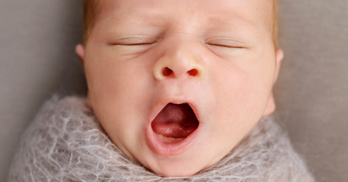 Understanding Pierre Robin Sequence in Babies - CHOC - Children's ...