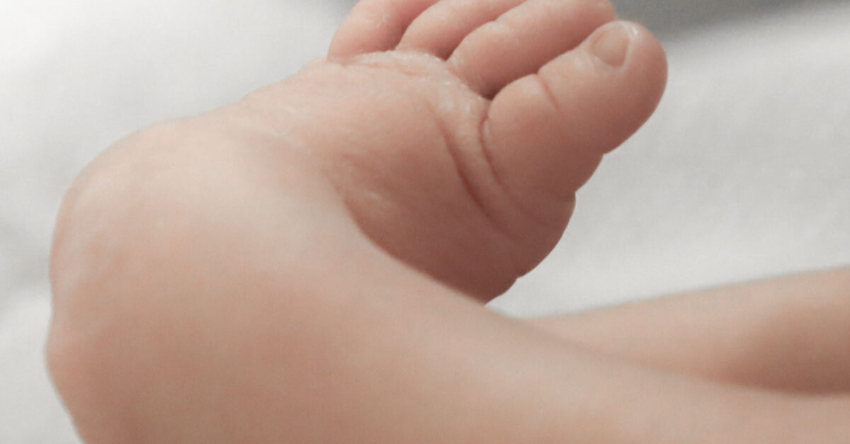 Clubfoot - CHOC - Children's Health Hub