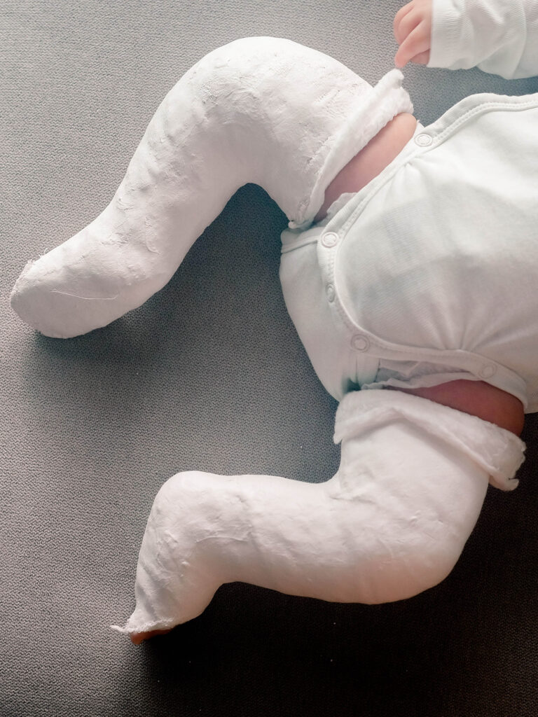 Clubfoot - CHOC - Children's health hub