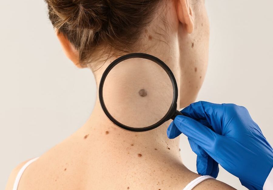 Moles and kids: An ultimate guide for parents - CHOC - Children's ...