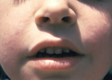 Parvovirus: What parents should know - CHOC - Children's Health Hub