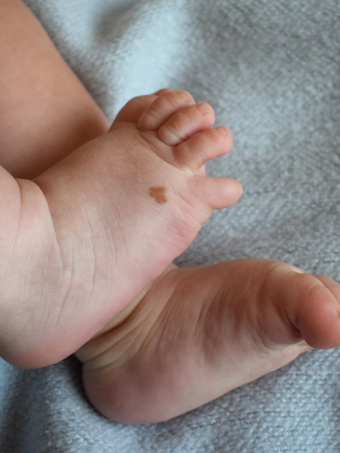 Moles and kids: An ultimate guide for parents - CHOC - Children's ...